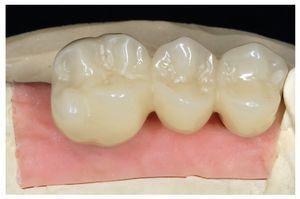 La confección racional de prótesis provisionales de PMMA sobre ...