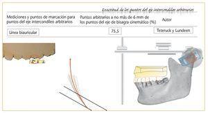 La transferencia con arco facial. Una visión personal de la ...
