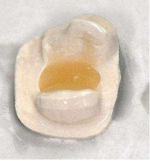 La «Inverse Layering Technique» | Quintessence Técnica