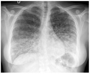 Capítulo 2. Patrón alveolar, intersticial, mixto y lesiones ...