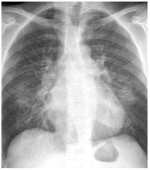 Capítulo 2. Patrón alveolar, intersticial, mixto y lesiones ...