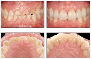 Clasificación y tratamiento de la dentición maxilar anterior afectada ...