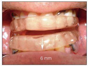 Efecto de la colocación de una férula de avance mandibular en la ...