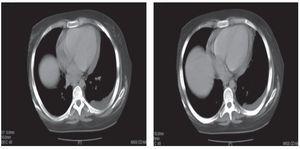 Absceso esplénico como complicación en un paciente con leucemia ...