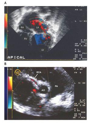 Anomalous origin of the Left Coronary Artery from the Pulmonary Artery ...