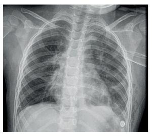 Bronquiolitis folicular linfoidea posterior a infección por adenovirus ...