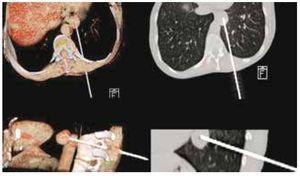 Biopsia pulmonar percutánea con Tru-cut ®:resultados en 200 casos ...