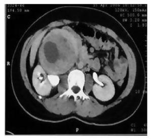 Neurilemoma (NLM) o schwannoma gigante retroperitoneal | Revista ...