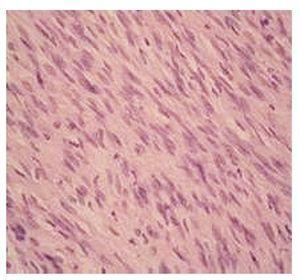 Neurilemoma (NLM) o schwannoma gigante retroperitoneal | Revista ...