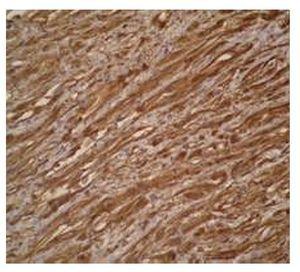 Neurilemoma (NLM) o schwannoma gigante retroperitoneal | Revista ...