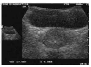 Media del volumen prostático por ecografía suprapúbica en jóvenes sanos ...