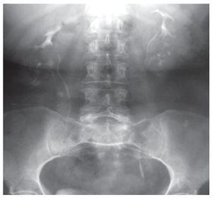 Litiasis renal bilateral y ureteral derecha en doble sistema colector ...