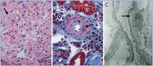 Postpartum hemolytic uremic syndrome with multiple organ involvement in ...