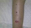 Acquired perforating dermatosis in patients with chronic renal failure ...