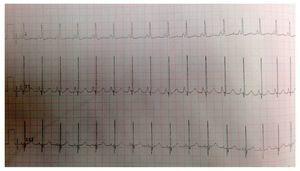 First case of a patient with late-onset Pompe disease: Cardiomyopathy ...